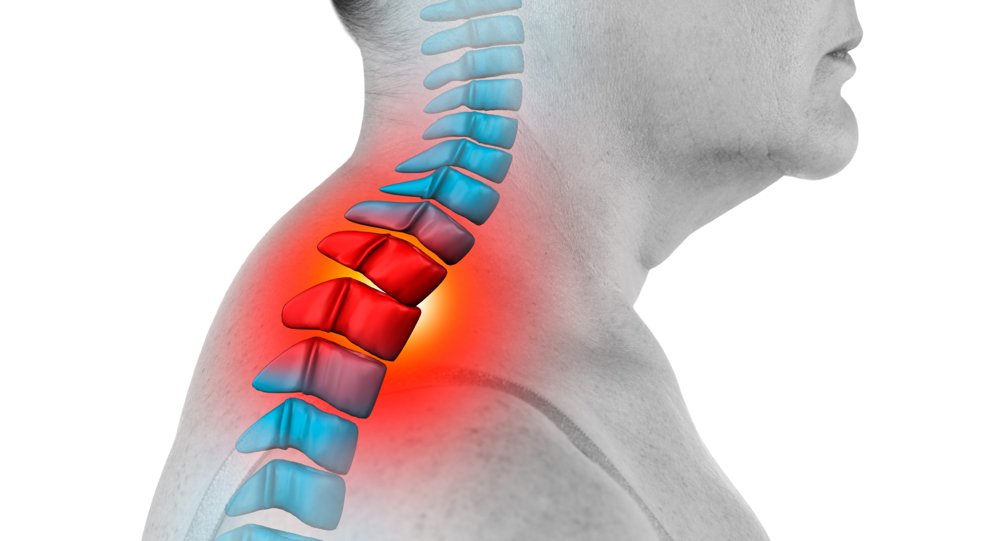 3 Exercises to Help You Quickly Get Rid of a Dowager's Neck Hump.